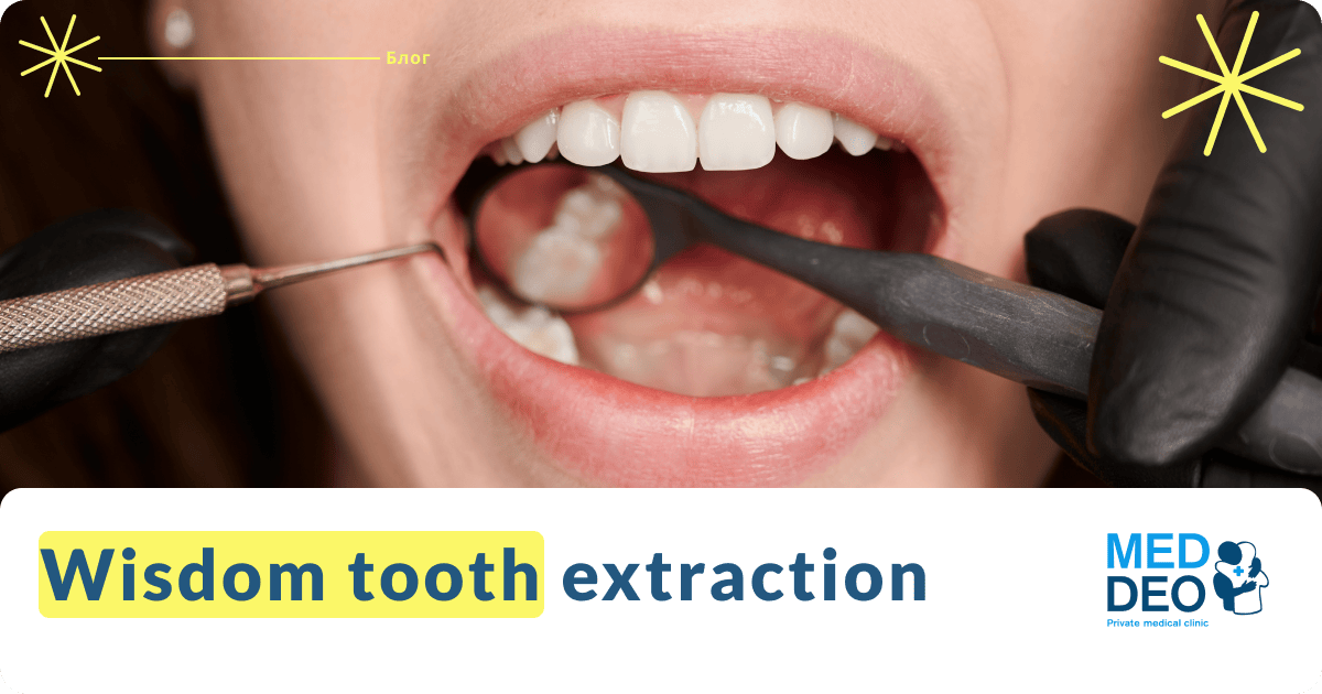 Wisdom Teeth Removal in Kyiv: Extraction Cost 2026 | Med-Deo Clinic