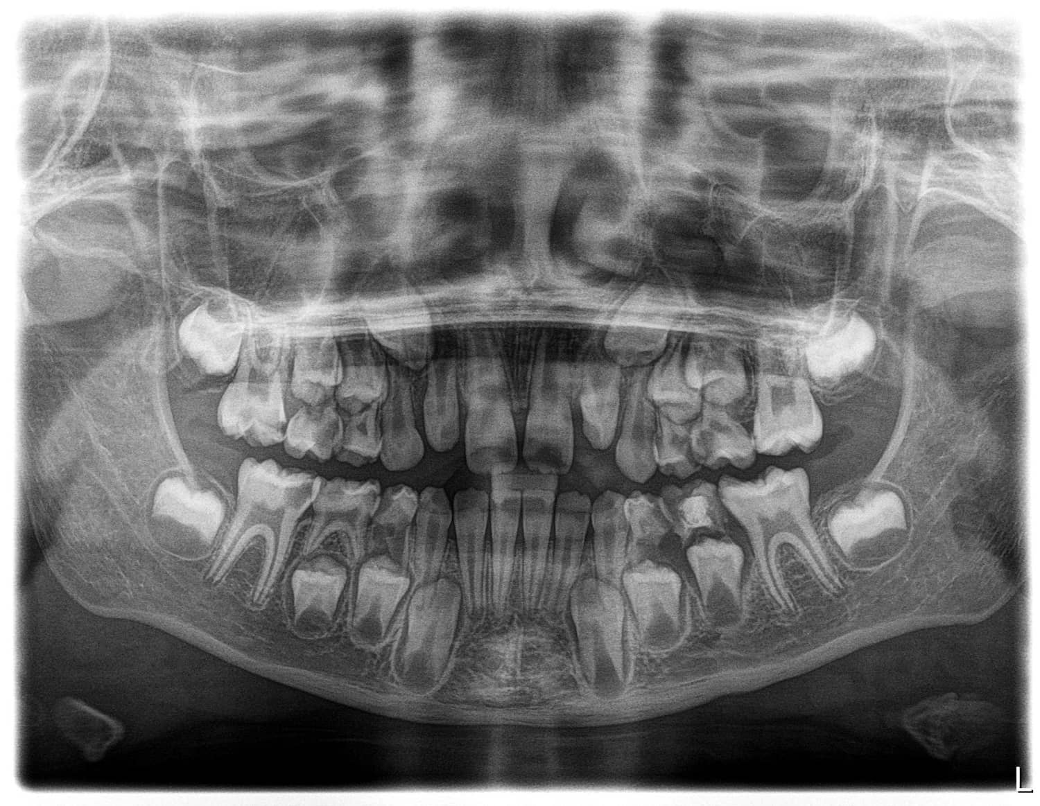 When and How Do Children's Teeth Appear? Tooth Growth Timeline.