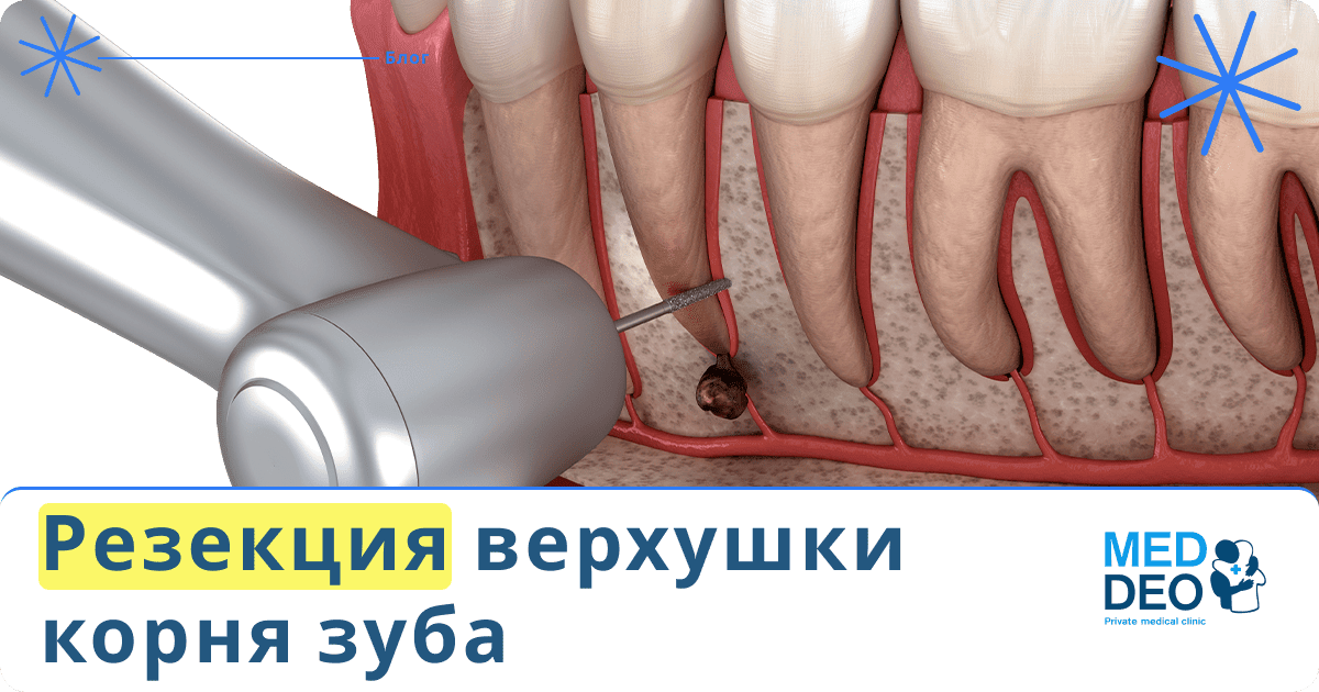 Root apex resection ☘️ Prices in Kyiv in 2026