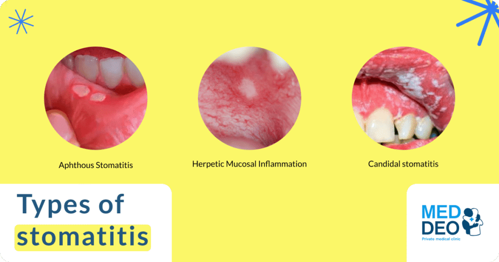 Stomatitis: Causes, Symptoms, and Treatment