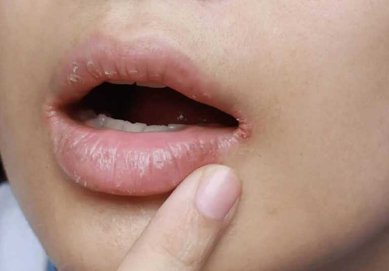 Angular Cheilitis: Causes, Fast Treatment & Prevention
