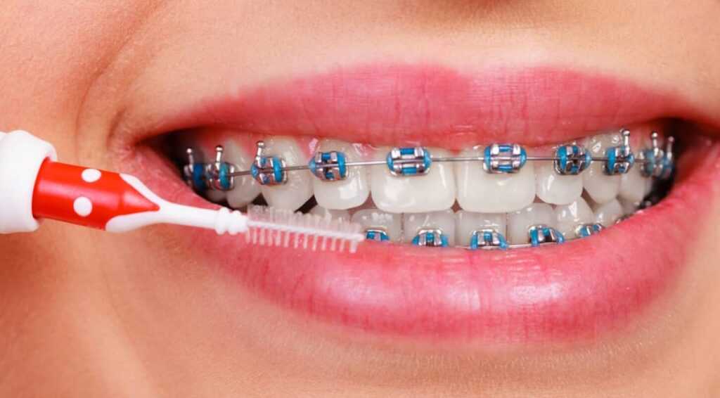 Types of Braces: Complete Guide to Choosing Your Perfect System