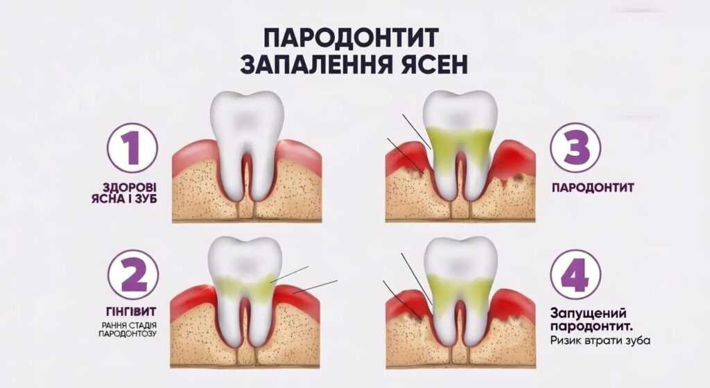 Periodontitis: Symptoms, Stages & Prevention | MED-DEO Blog