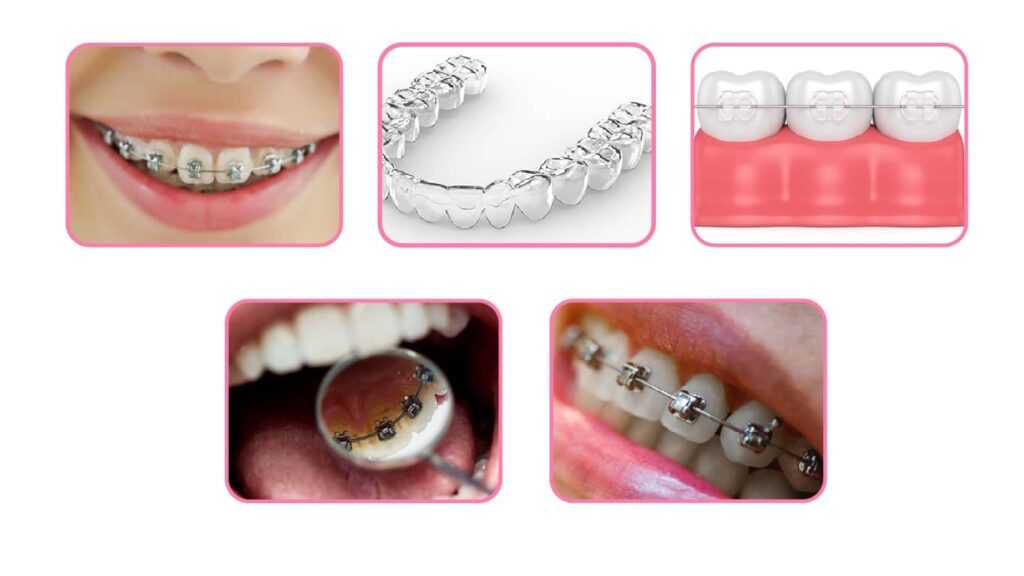 Types of Braces: Complete Guide to Choosing Your Perfect System