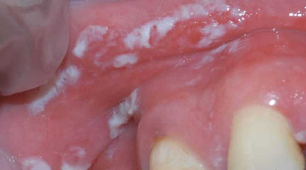 White Plaque on the Gums: Causes, Types, and Treatment Methods